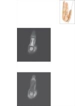 Cross Section of the Thumb: Coronal View
