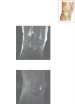 Cross Section of the Knee: Coronal View