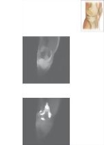 Cross Section of the Knee: Coronal View