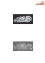 Cross Section of the Ankle and Foot: Coronal View