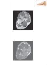Cross Section of the Ankle and Foot: Coronal View