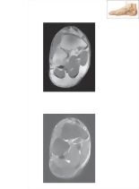 Cross Section of the Ankle and Foot: Coronal View