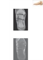 Cross Section of the Ankle and Foot: Coronal View