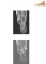 Cross Section of the Ankle and Foot: Coronal View