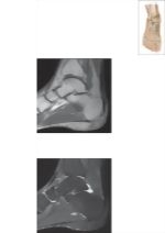 Cross Section of the Ankle and Foot: Coronal View