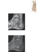 Cross Section of the Ankle and Foot: Coronal View