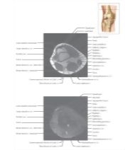 Cross Section of the Knee: Axial View