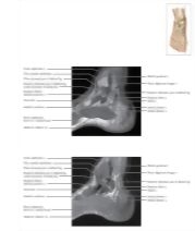 Cross Section of the Ankle and Foot: Coronal View