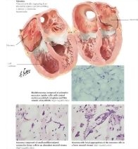 Heart Tumors