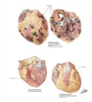 Metastatic Heart Tumors