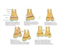 Injury to Growth Plate (Salter-Harris Classification)