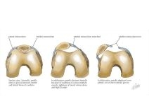 Subluxation and Dislocation of Patella
