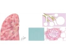 Pathogenesis of Bronchiolitis