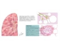 Pathogenesis of Bronchiolitis