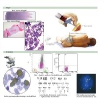 Bone Marrow Biopsy
