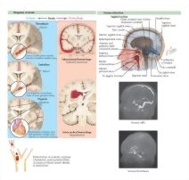 Diagnosis of Stroke