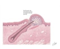 Shaving: A Cause of Skin Disorders