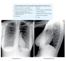 Systematic Chest X-Ray Evaluation