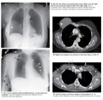 Search Strategy: Thoracic Wall Soft Tissues (Air, Calcification ...