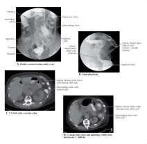 Large Intestine Imaging Studies