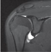 Shoulder Joint Imaging Studies: Coronal T2 MRI