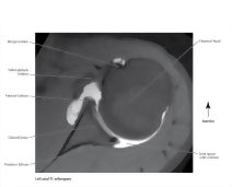 Shoulder Joint Imaging Studies (Axial T1 Arthrogram)