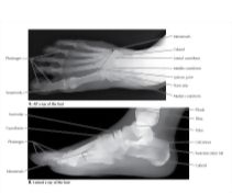 Radiographs of the Foot
