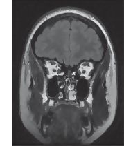 T2 FLAIR Coronal MRI Through the Frontal Lobes