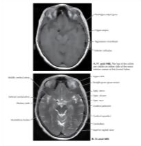T1 and T2 Axial MRI Through the Optic Chiasm