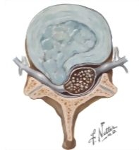 Schematic Cross Section Showing Compression of Nerve Root