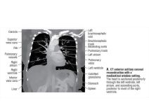 CT Anterior Axillary Coronal Reconstruction With a Mediastinal Window ...