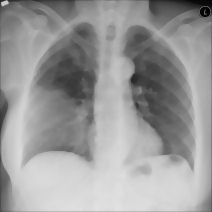 Search Strategy: Thoracic Wall Soft Tissues (e.g., Air, Calcification ...