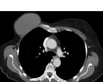 Search Strategy: Thoracic Wall Soft Tissues (e.g., Air, Calcification ...