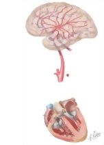 Stroke As a Result of Cardiac Embolus
