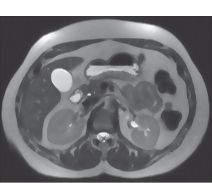 CT Vs. MRI In Abdominal Studies