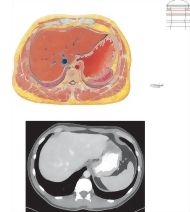Cross Section at T10 With CT