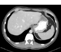 Cross Section at T10 With CT