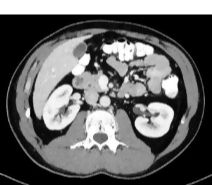 Cross Section at L1-L2 With CT
