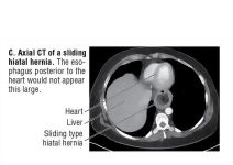 Hiatal Hernia