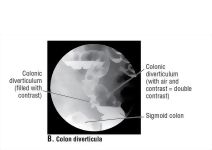 Large Intestine Imaging Studies