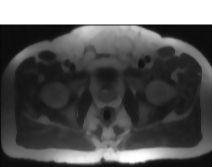 T2-Weighted MRI Showing Prostate Gland Detail