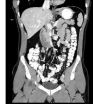 Coronal CT Through Male Urinary Bladder