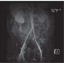 MRA With Maximum Intensity Projection (MIP)