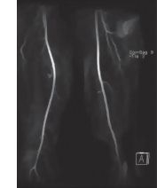 MRA With Maximum Intensity Projection (MIP) of Relatively Normal ...