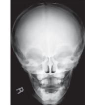 Anteroposterior (AP) X-Ray of a Child