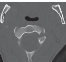 Axial CT Showing C2 Fracture
