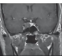 Coronal MRI Showing a Small Tumor (Microadenoma) In the Right Half of the Pituitary Gland