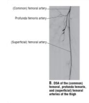 DSA of the (Common) Femoral, Profunda Femoris, and (Superficial ...