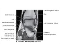 Coronal T1 MRI Through the Ankle Joint