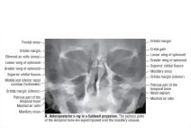 Anteroposterior X-Ray In a Caldwell Projection